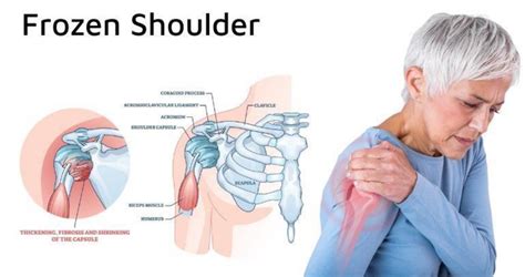 A Comprehensive Guide To Treating Frozen Shoulders In Bangalore
