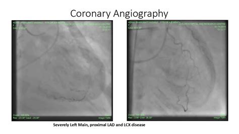 Severely Left Main Proximal Lad And Lcx Disease Youtube