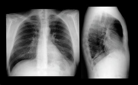 Lung Infection Photograph By Aj Photoscience Photo Library Pixels