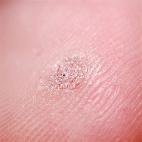 Ticklish Feet Its A Touchy Subject Advanced Foot Care Of Nj Llc