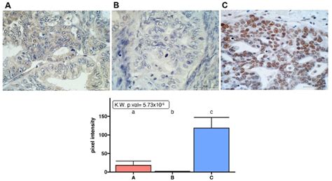 Immunohistochemical Expression Of Ifi16 In Endometroid Adenocarcinoma