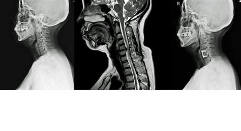 O Que é Cervicalgia Quais As Causas Sintomas E Tratamento Clínica