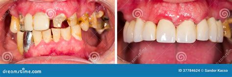 Dentadura Antes E Depois Do Tratamento Foto De Stock Imagem De