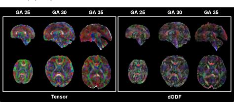 Anatomically Constrained Tractography Of The Fetal Brain Paper And