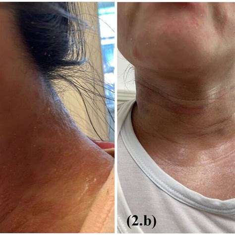 Erythema Scaling And Lichenification Of The Face And Neck Before