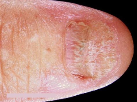 Lichen Planus Causes What It Looks Like How To Get Rid Of It