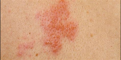 Como Curar La Culebrilla O Herpes Zoster