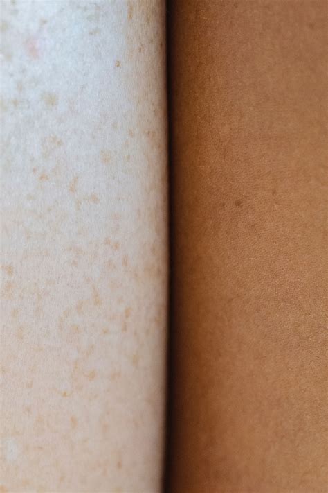 Hyperpigmentation Treatment In Dallas Lemmon Avenue