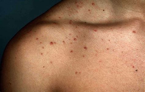 Mallorca Acne Acne Aestivalis