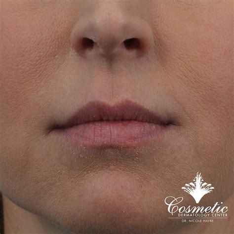 Dermal Fillers Treatments In Mclean Va Cosmetic Dermatology Center