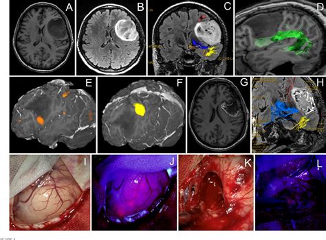 Figure 1 From 5 Ala Guided Tumor Resection During Awake Speech Mapping In Gliomas Located In