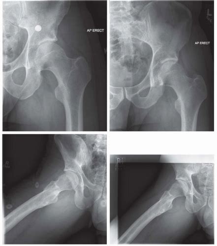 Hip Arthroscopy Musculoskeletal Key