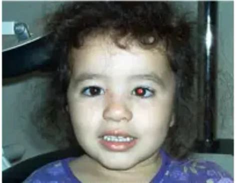 Clinical Examination Of Ocular Alignment And Binocular Vision In Infants Under Six Months Of Age