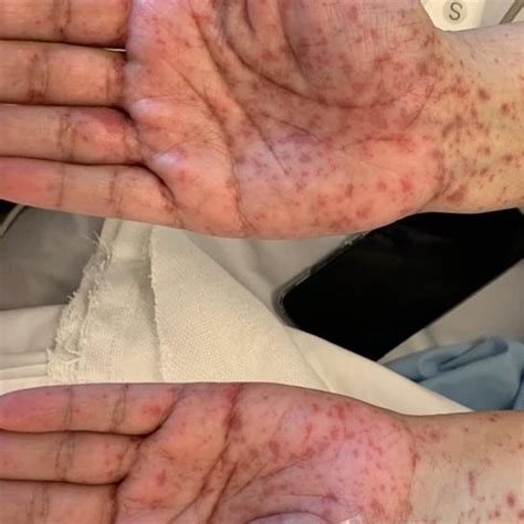 Generalised Maculopapular Rash With Target Lesions On Lower Limbs