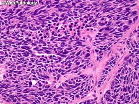 Small Cell Lung Cancer Histology Research