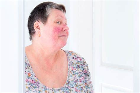 Skin Conditions That Look Like Acne Readers Digest