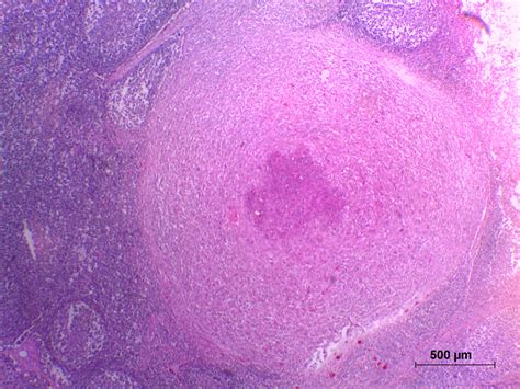 Tuberculosis Histology