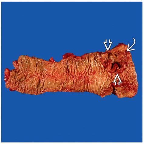 Colon Diagnosis And Margins Basicmedical Key