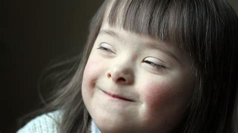 What Are The Symptoms Of Williams Syndrome