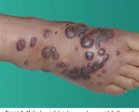 Figure 1 From Synchronous Pyoderma Gangrenosum And Inflammatory Bowel Disease Healing After