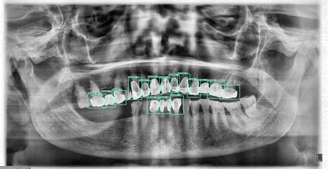 Improving Deep Learning Object Detection On Dental X Rays Clement Joudet Blog