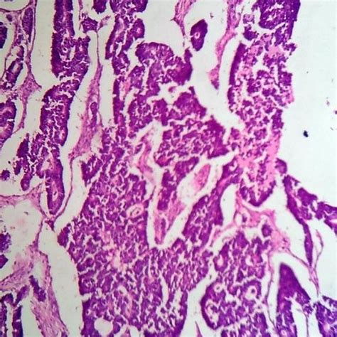 Microscopical Examination Revealed Features Of Mature Cystic Teratoma