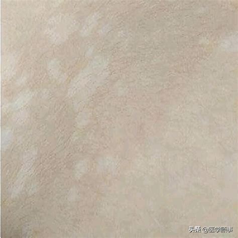 达克宁治疗汗斑吗？