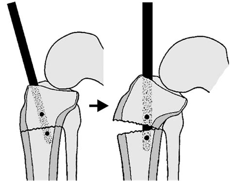 Posteriorly Directed Insertion Of The Nail Into The Proximal Fragment Download Scientific