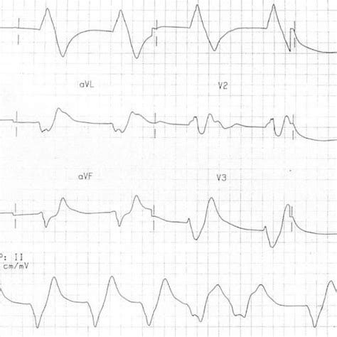 Hyperkalemia Ecg Sine Wave