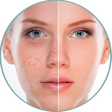 White Spots On Face Ph