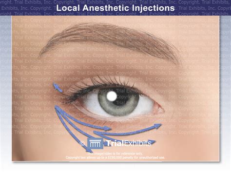 Local Anesthetic Injections Trialquest Inc