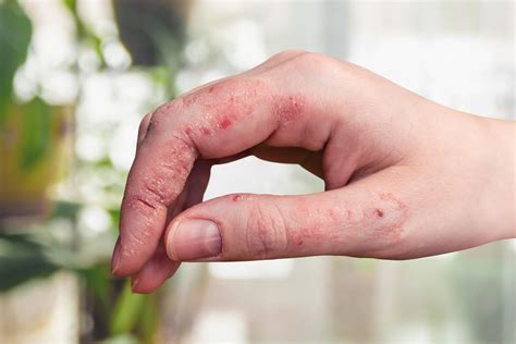 Aaaai And Acaai Offer Updated Practice Parameters On Anaphylaxis And Atopic Dermatitis Diagnosis