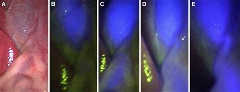 Feasibility Of Near Infrared Cholecysto Cholangiography And Evaluation