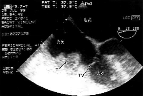 A Case Of Cardiac Angiosarcoma Presenting As Pericardial Tamponade Heart
