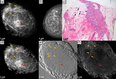 Dose And Spatial Resolution Analysis Of Grating Based Phase Contrast Mammography Using An
