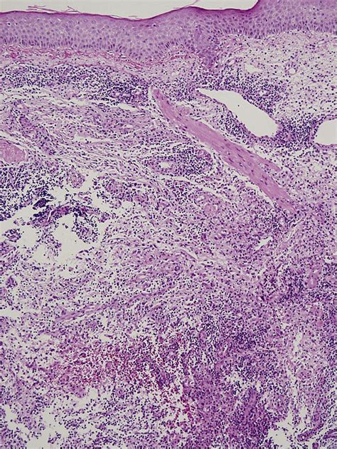 Mycobacterium Fortuitum Infection Associated With Acupoint Embedding