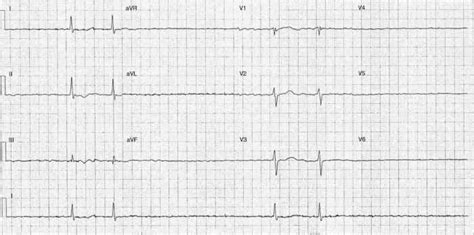 Ecg Case 241 Manual Of Medicine