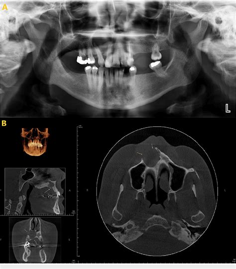 Figure 2 From The Utility Of Cone Beam Computed Tomography Scans In Diagnosing And Treating