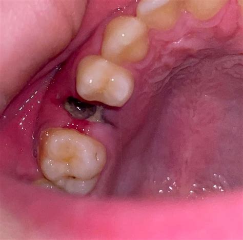 Dry Socket Treatment Home Remedies Alveolar Osteitis 58 Off