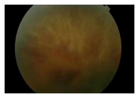 Fundus Photographs Of Branch Retinal Vein Occlusion Secondary To