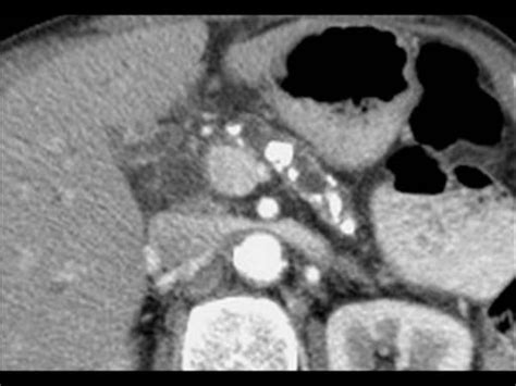 Abdomen And Retroperitoneum 1 3 Pancreas Case 1 3 7 Pancreas Calcifications Ultrasound Cases