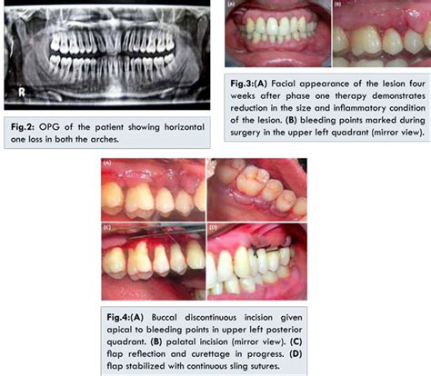 A Curious Case Of Plasma Cell Gingivitis