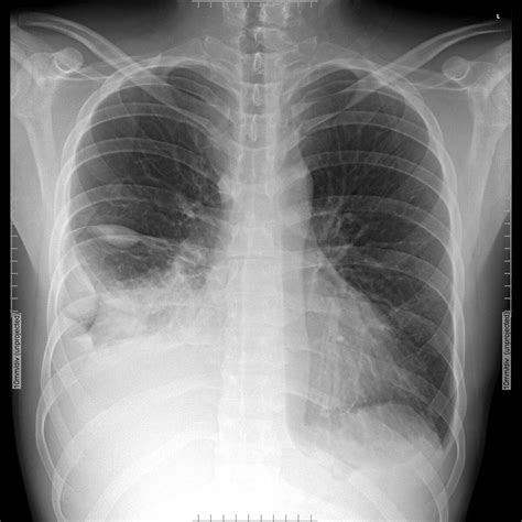 Radiopaedia Case Complicated Submandibular Abscess With Mediastinitis