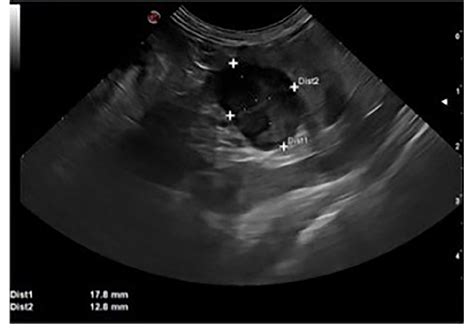 Abdominal Ultrasound Showing A Heterogeneous Nodular Structure