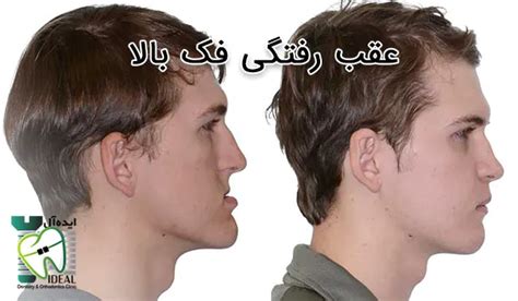 دلیل عقب بودن فک بالا چیست؟ راه درمان بدون جراحی یا با جراحی