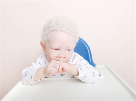 Albinism In Humans Pictures 26 Photos And Images