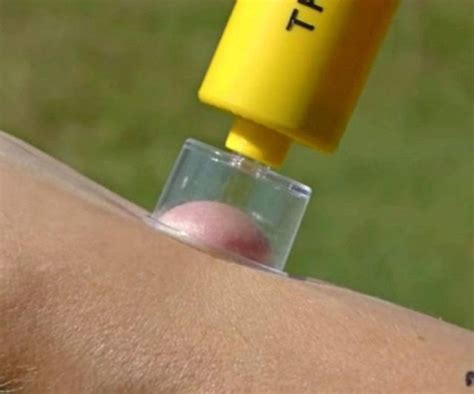 Stop Stings In Their Tracks The Bite And Sting Extractor Kit You Cant