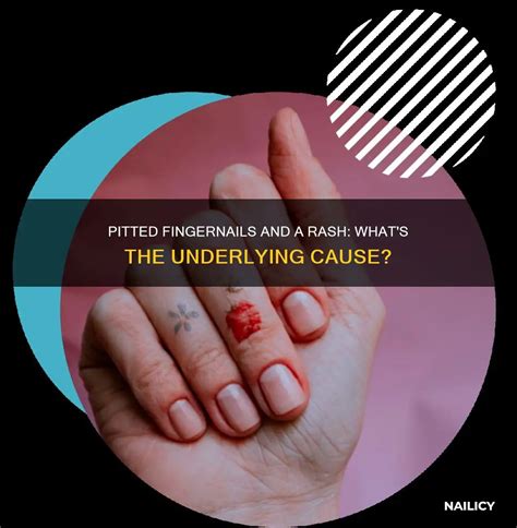 Pitted Fingernails And A Rash Whats The Underlying Cause Nailicy