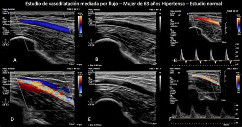 Flujos Doppler E Imágenes Que Se Deben Conocer Parte 1 Flujo Doppler