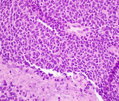 Histologia Do Sarcoma De Ewing Condrosarcoma Condroma Historia